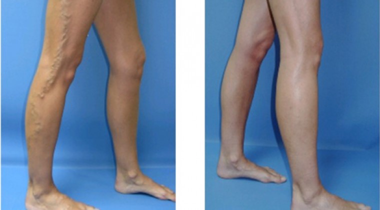 Diario HOY | Reportan 'epidemia' de várices en hombres, agravada por la ...