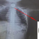 Diario HOY | Pila explotó en el esófago de una niña de 2 años y le ...